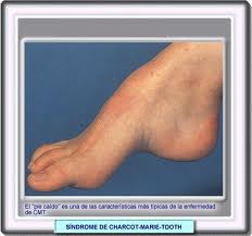 Charcot-Marie-Tooth