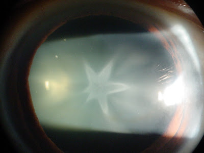 Oftalmología: Catarata traumática con forma de estrella