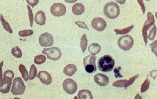 Hematologia: Anemia Falciforme