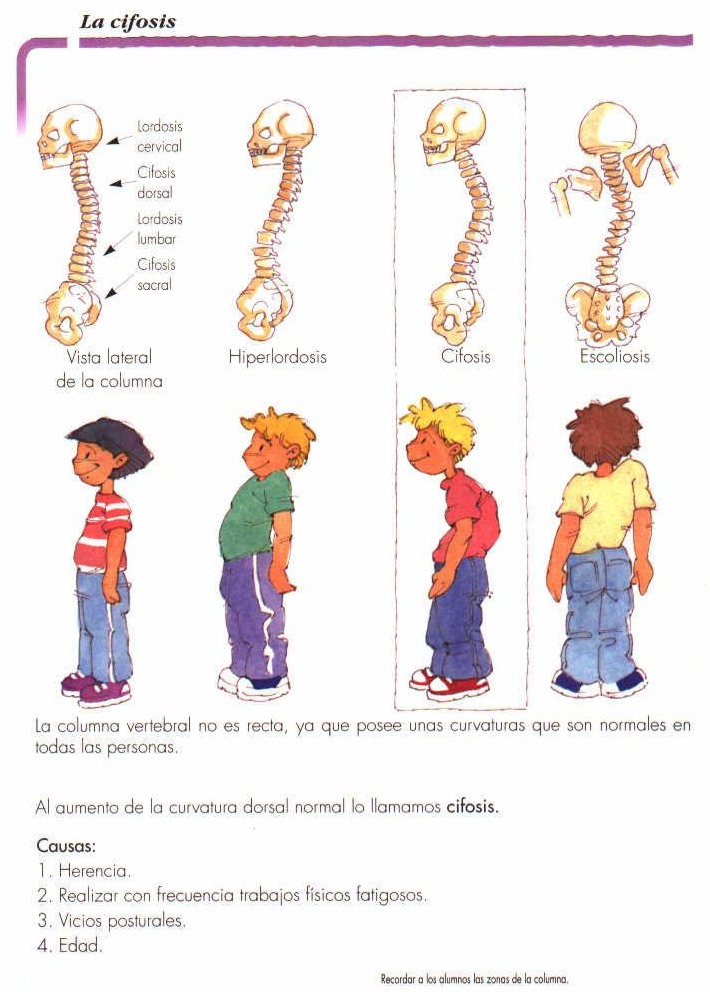 Educación Física en la Red: Cifosis: ejercicios preventivos
