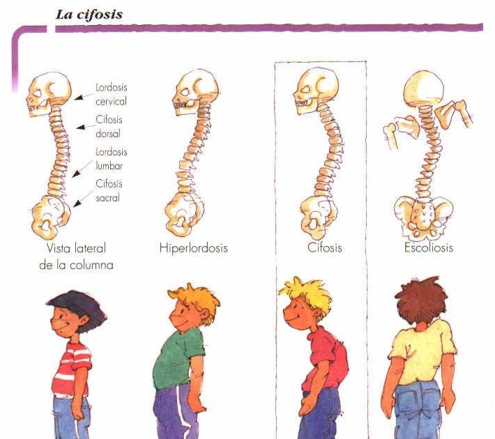 Educación Física en la Red: Cifosis: ejercicios preventivos