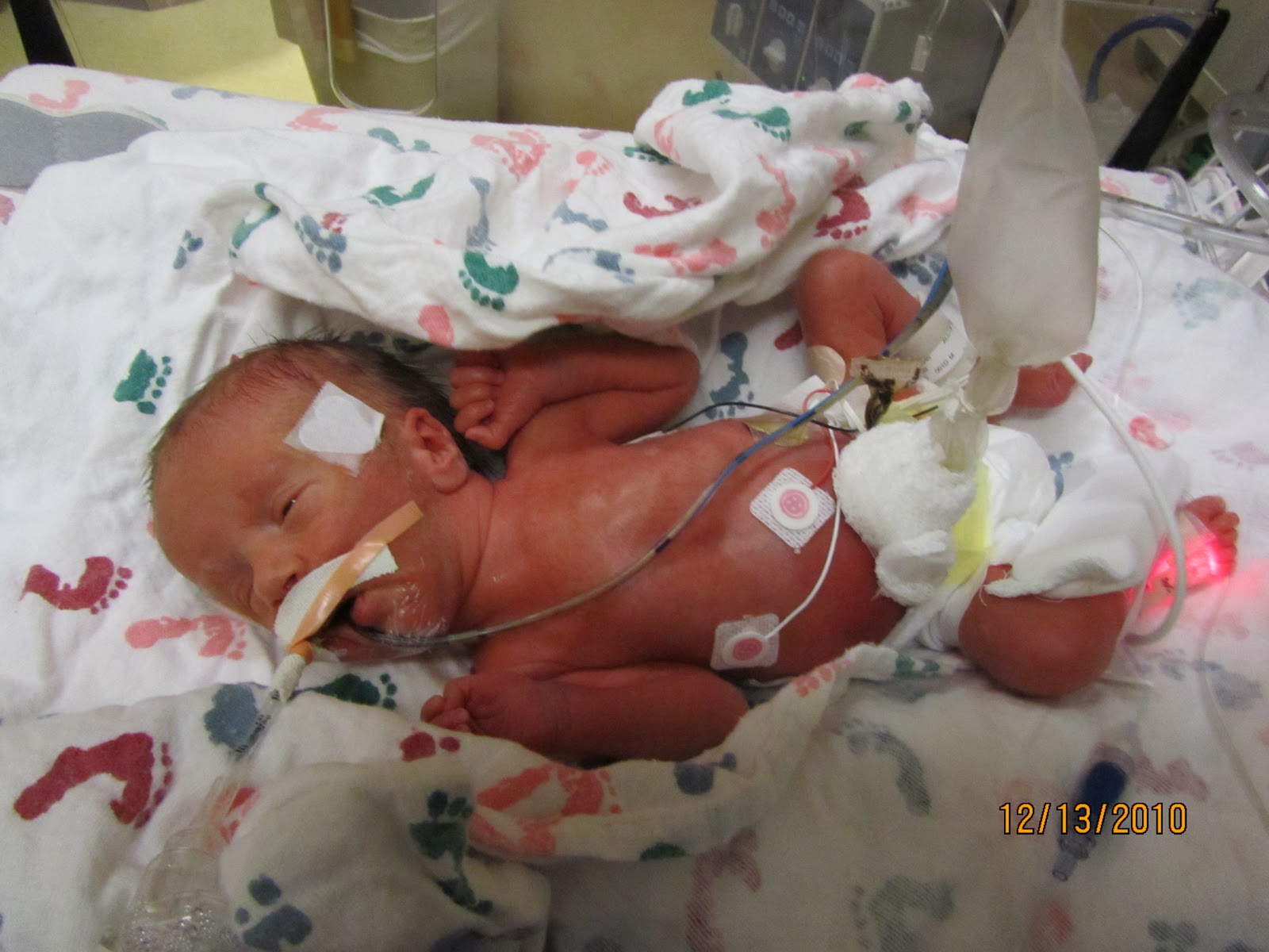 Jacob's Page: 5 days old Primary Closure surgery today and Broviac ...