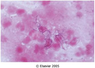 laboratorio de patología: Nocardia asteroides