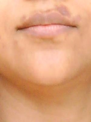 Case Summary-Facial Herpes Simplex Infection « Use Homeopathy And Be ...