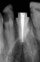 My Blogs: "The Ferrule Effect"