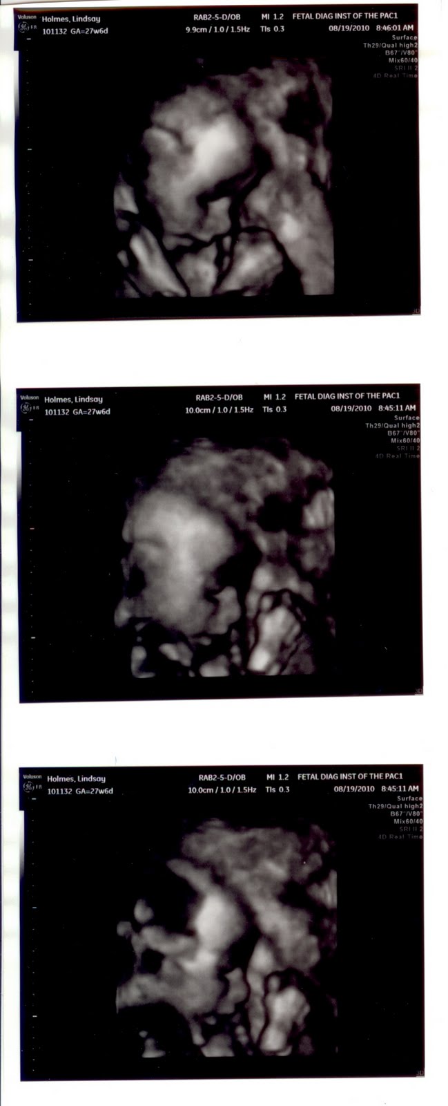 The Holmes Ohana: 28 week ultrasound
