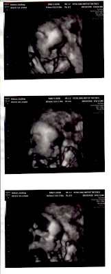 The Holmes Ohana: 28 week ultrasound