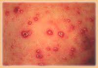 Patologias Virais: Varicela