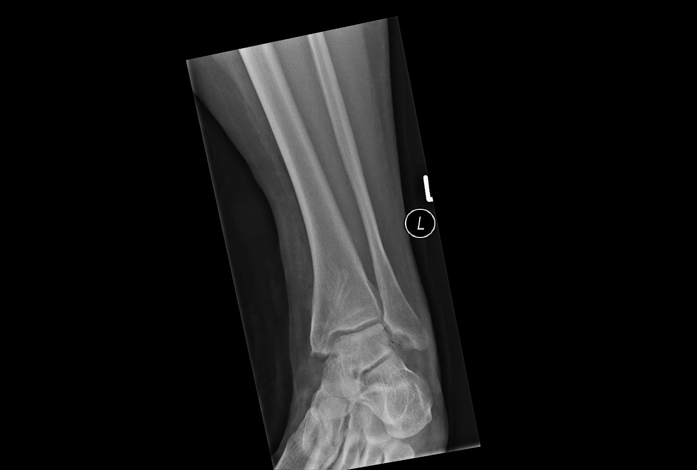 Sprunggelenksarthrose bei Osteochondrosis dissecans beider OSG ...