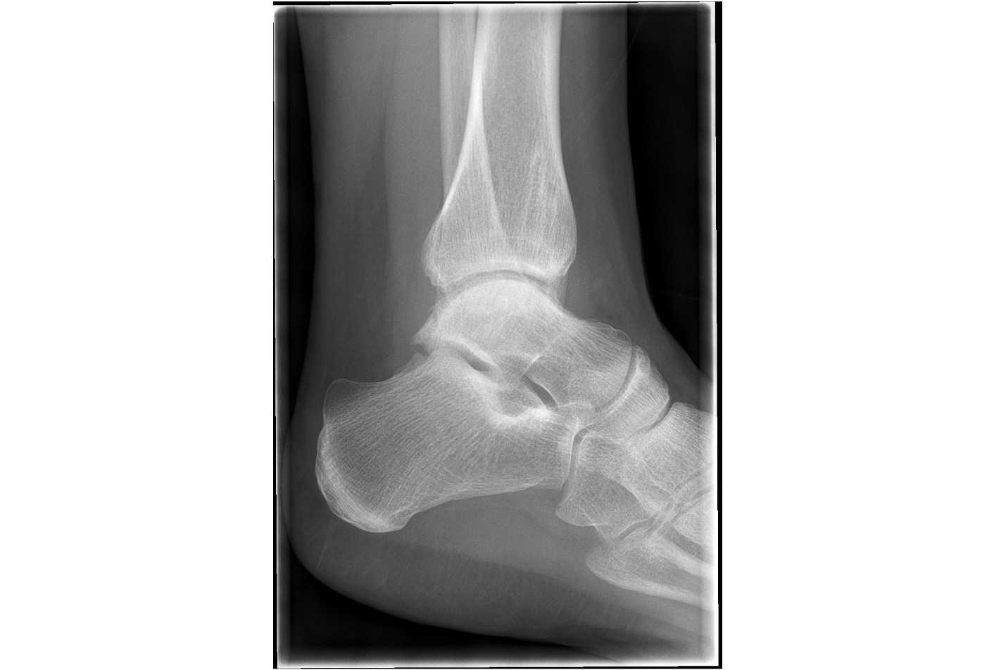 Sprunggelenksarthrose bei Osteochondrosis dissecans beider OSG ...