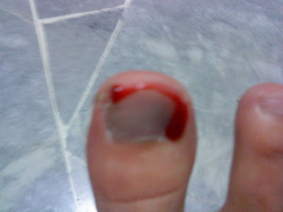 SHAKELINGAM!!!™: Bloody toe! (may not be suitable for minors)