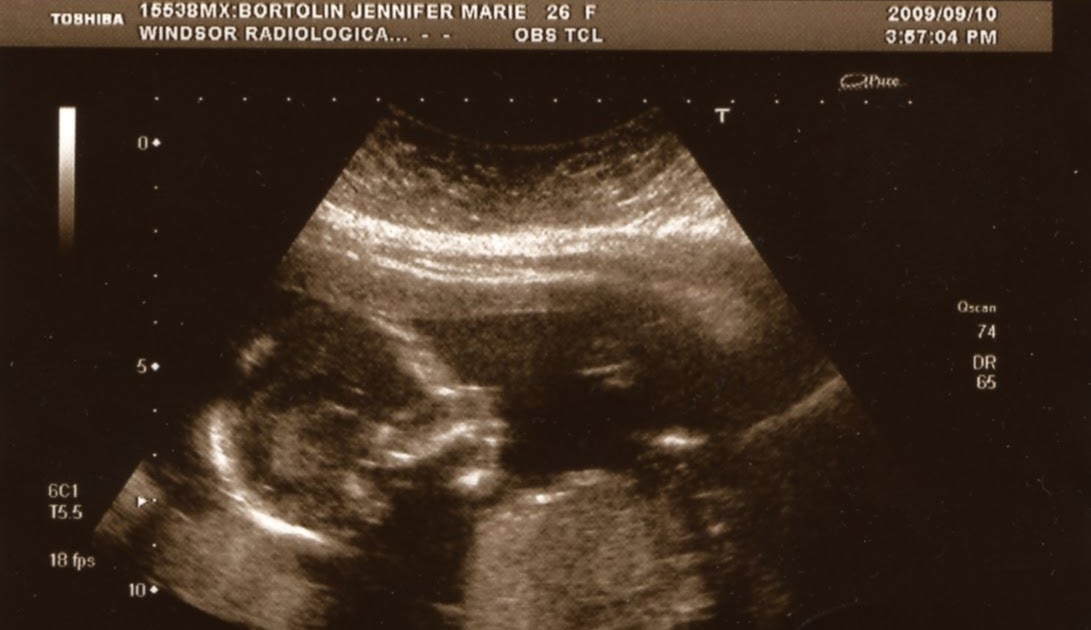20 week ultrasound 4d - molisz