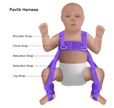Developmental Dysplasia of the Hip (DDH)