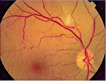 PREVENIR LA CEGUERA: CEGUERA TRANSITORIA: AMAUROSIS FUGAZ