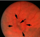 PREVENIR LA CEGUERA: DESGARROS Y AGUJEROS DE RETINA...