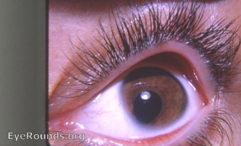 PREVENIR LA CEGUERA: COLOBOMA UVEAL: INVESTIGACION, ESTUDIOS...