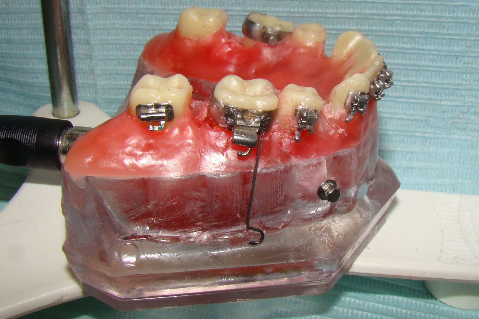 AVALOS_BM_MT: VERTICALIZACION DE MOLARES CON MINITORNILLOS