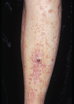 Homeopathy Health Care: Pruritus