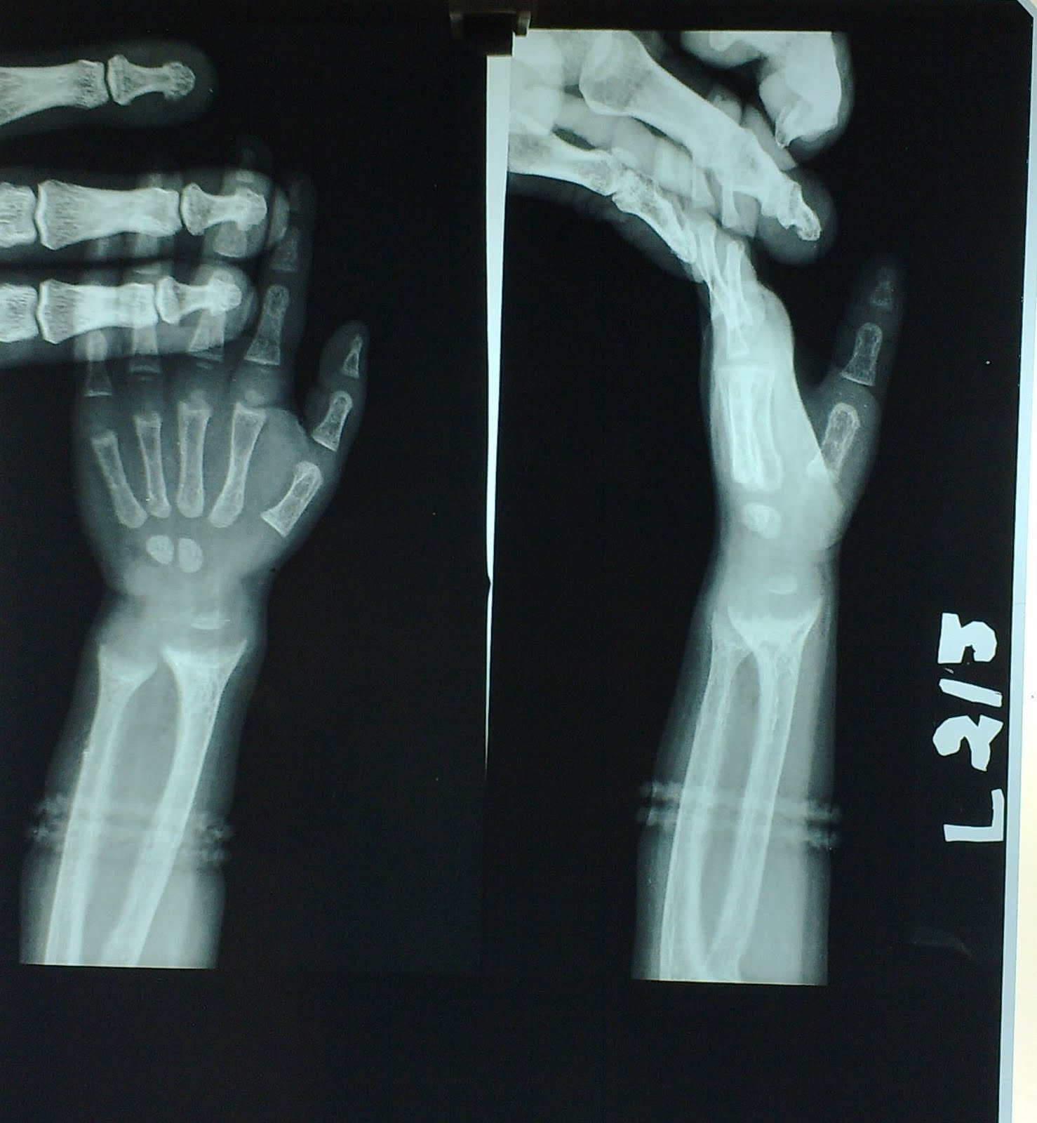 IRRADIATED - Radiology: RICKETS - A Case Report