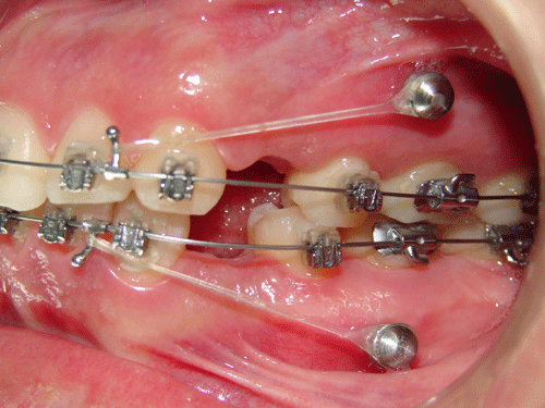 GICAI, "Creadores de Sonrisas": Microimplantes o Mini implantes en ...