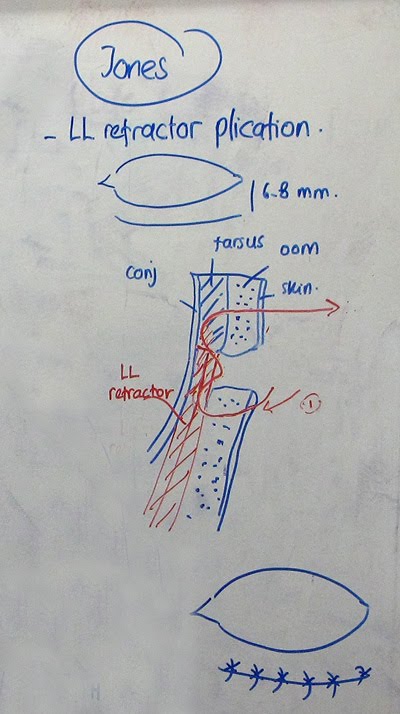 UKM Ophthal Part 2 2010: Entropion