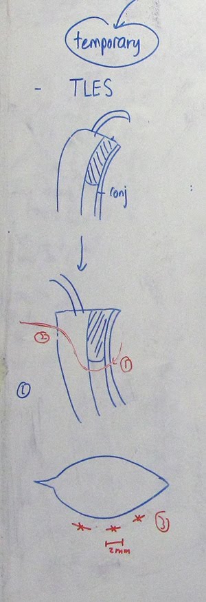 UKM Ophthal Part 2 2010: Entropion