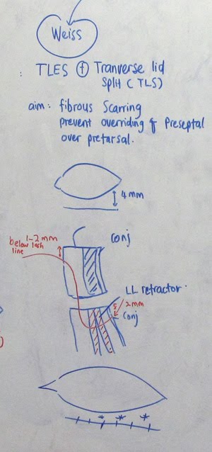 UKM Ophthal Part 2 2010: Entropion
