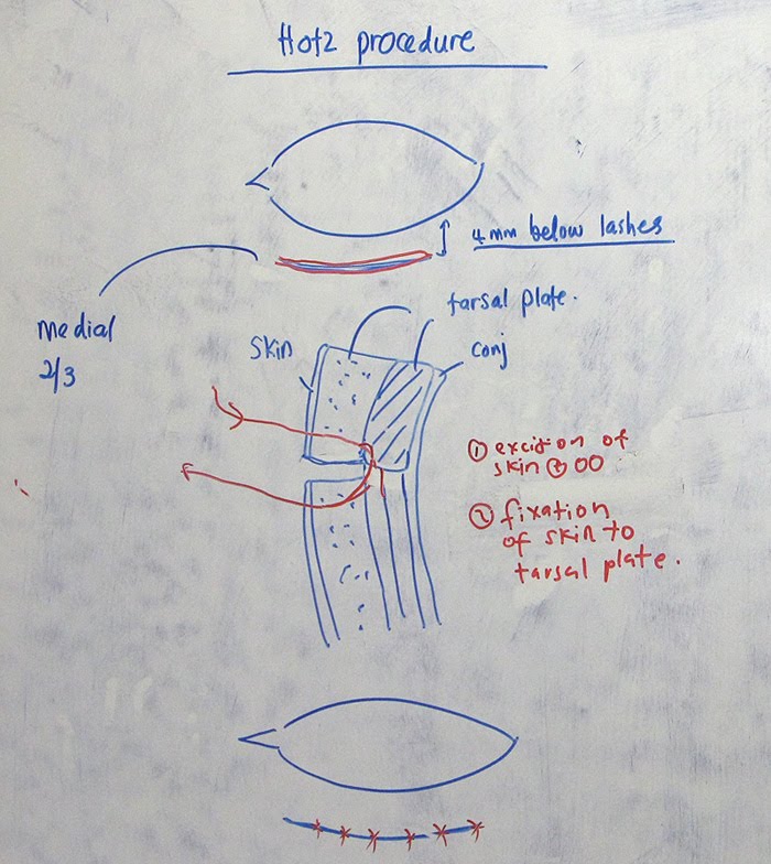 UKM Ophthal Part 2 2010: Entropion