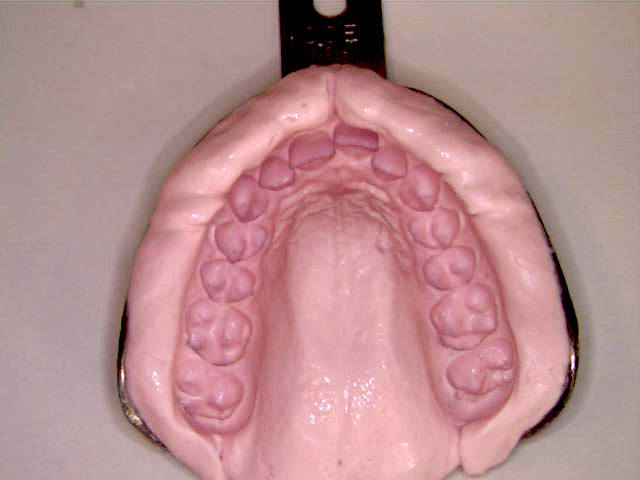 First Step: Getting Dental Impression | 966 Days of Braces