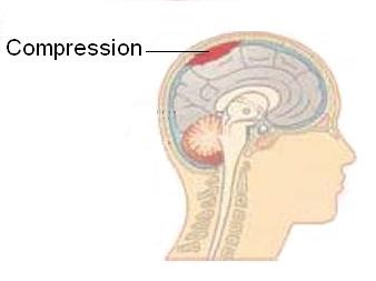 FirstAid4Free: Head Injuries 2: COMPRESSION