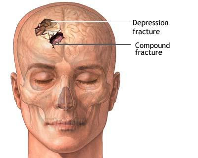 FirstAid4Free: Head Injuries 3: SKULL FRACTURE