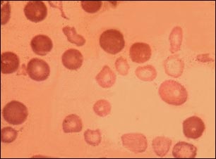 Epidemiologia Escobar: Talasemia - Epidemiiologiaescobar