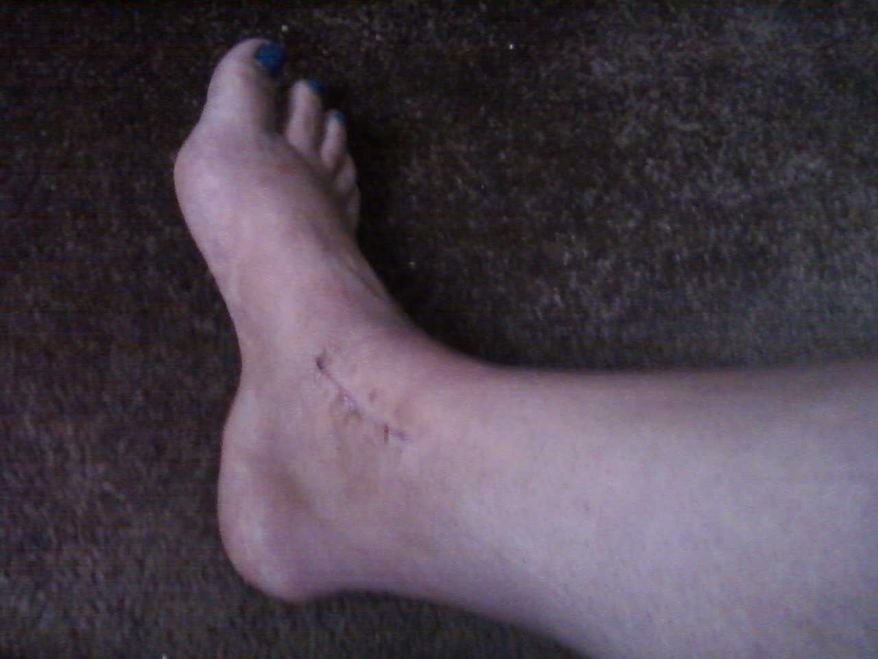 titanium hurts...LB's daze of recovery: LB's progression: from wobble ...