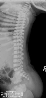 Orthopaedic Surgery CME: X-ray of te day: Osteopetrosis