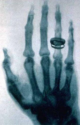 LA RADIOACTIVITE DANS LA MEDECINE.: 1. Radiographie.