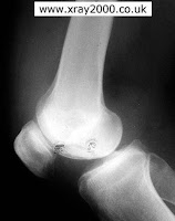 Radiography at ECC: Electric Charge and Static Electricity