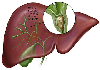 Gallstone and its Prevention - Travel and Health