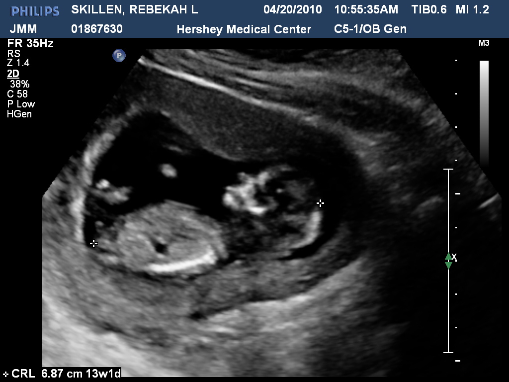 BEK Life: First Trimester Prenatal Screening and Ultrasound Exam