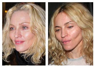 Plastic Surgery Celebrity Before And After: Madonna Plastic Surgery