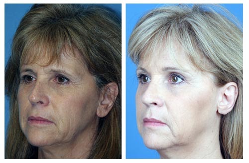 Plastic Surgery Before And After: Temporal Brow Lift