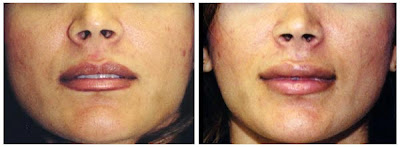 Plastic Surgery Before And After: Lip Augmentation Before And After