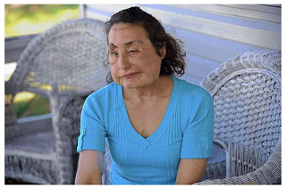 Plastic Surgery Before And After: Connie Culp Before And After