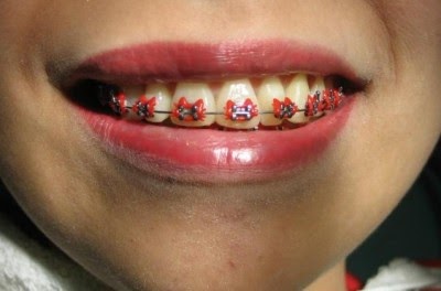 Catsparella: Hello Kitty Braces
