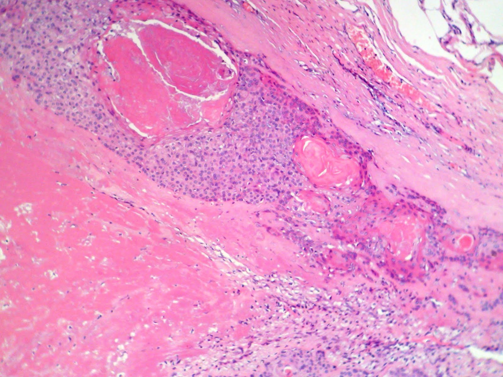 HISTOPATHOLOGY: Scalp swelling