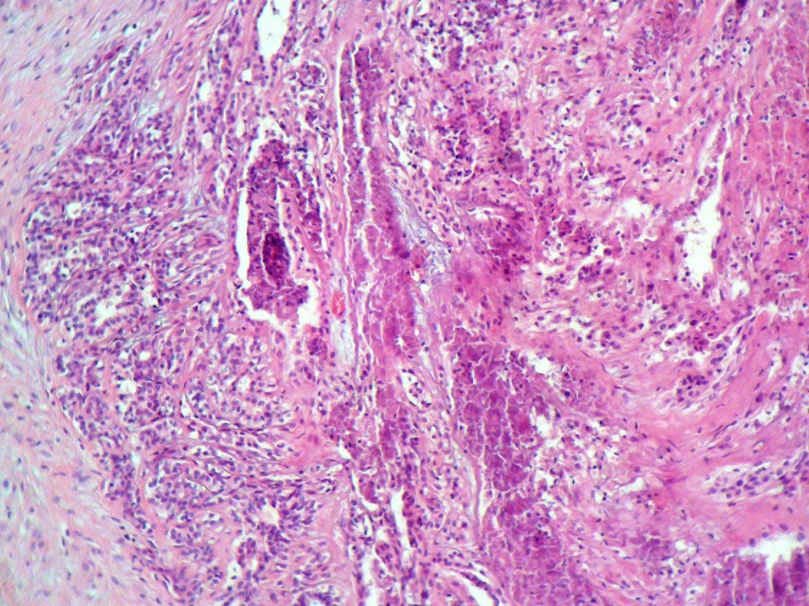 HISTOPATHOLOGY: Retroareolar breast lump