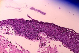Trigonitis
