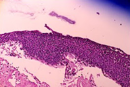 Trigonitis