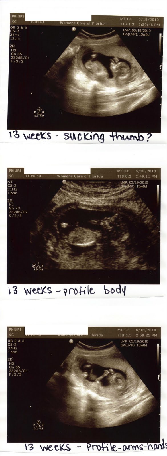 Delivery Girl: NT scan 13 weeks