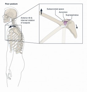Direct Performance Physical Therapy Blog: Postural Abnormalities and ...
