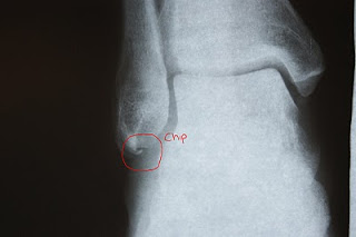 Clean Up Set: Bone chip.........Ouch!